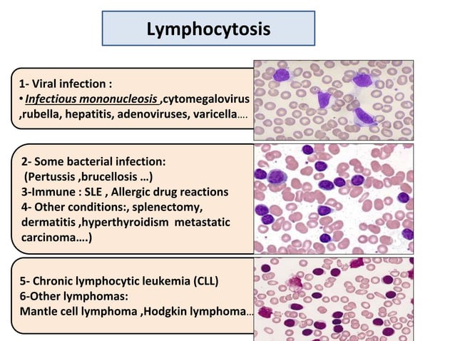 Lymphoproliferative disorders (lecture) | PPTX | Infectious Diseases ...