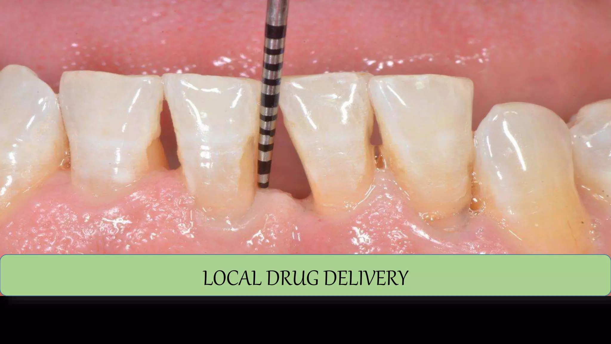 local drug delivery in periodontics | PPTX