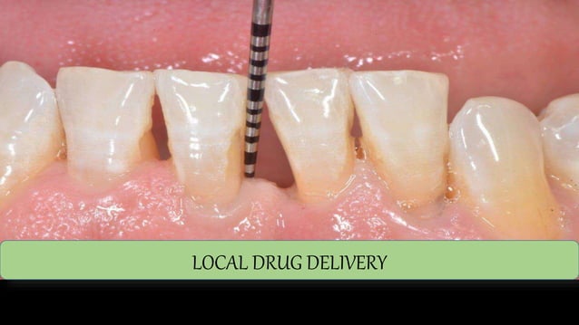 local drug delivery in periodontics | PPTX | Dental Health | Diseases ...