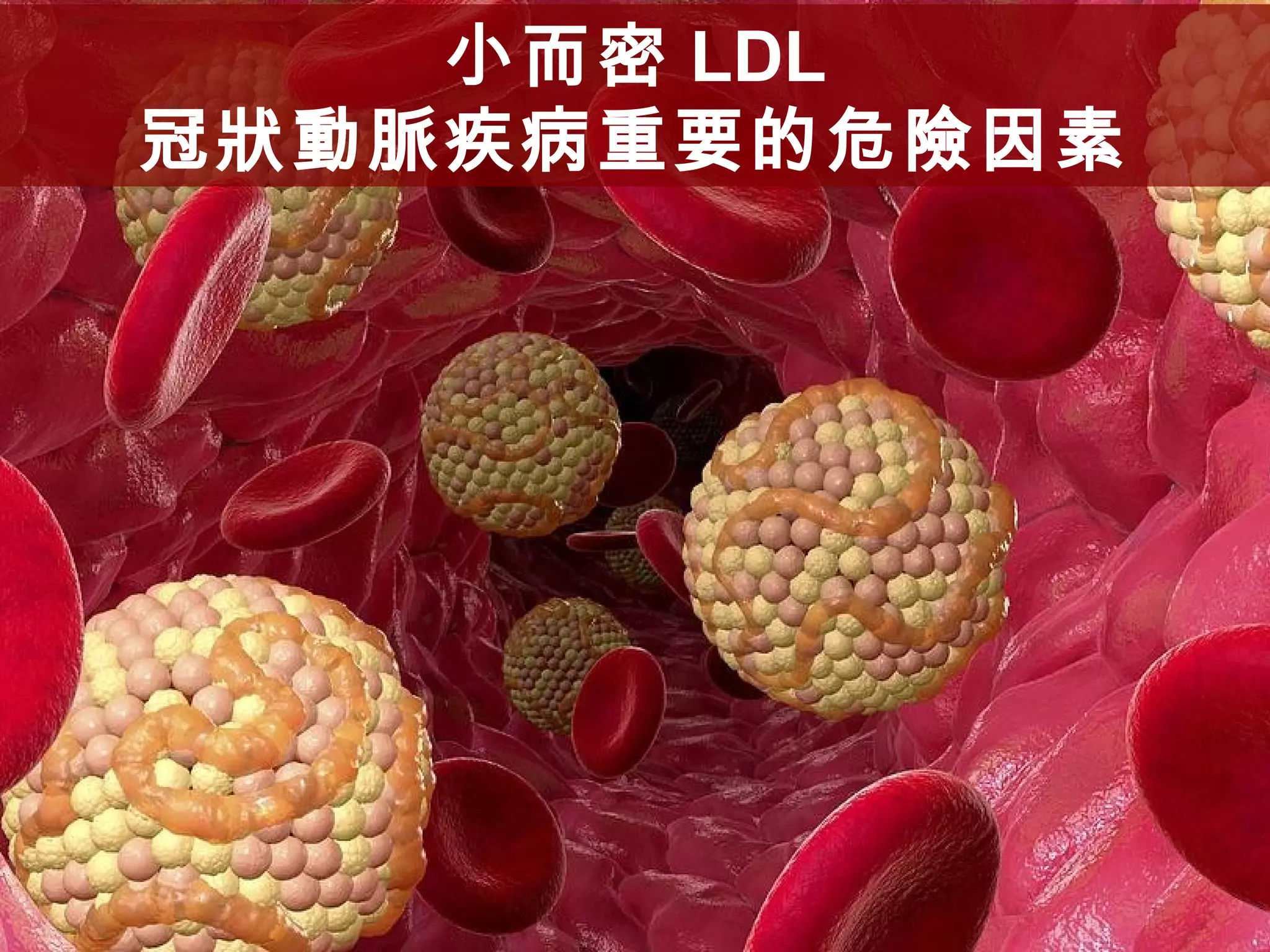Three-Hypers Series：Hyperlipidemia – 07 Small, dense LDL - an important ...