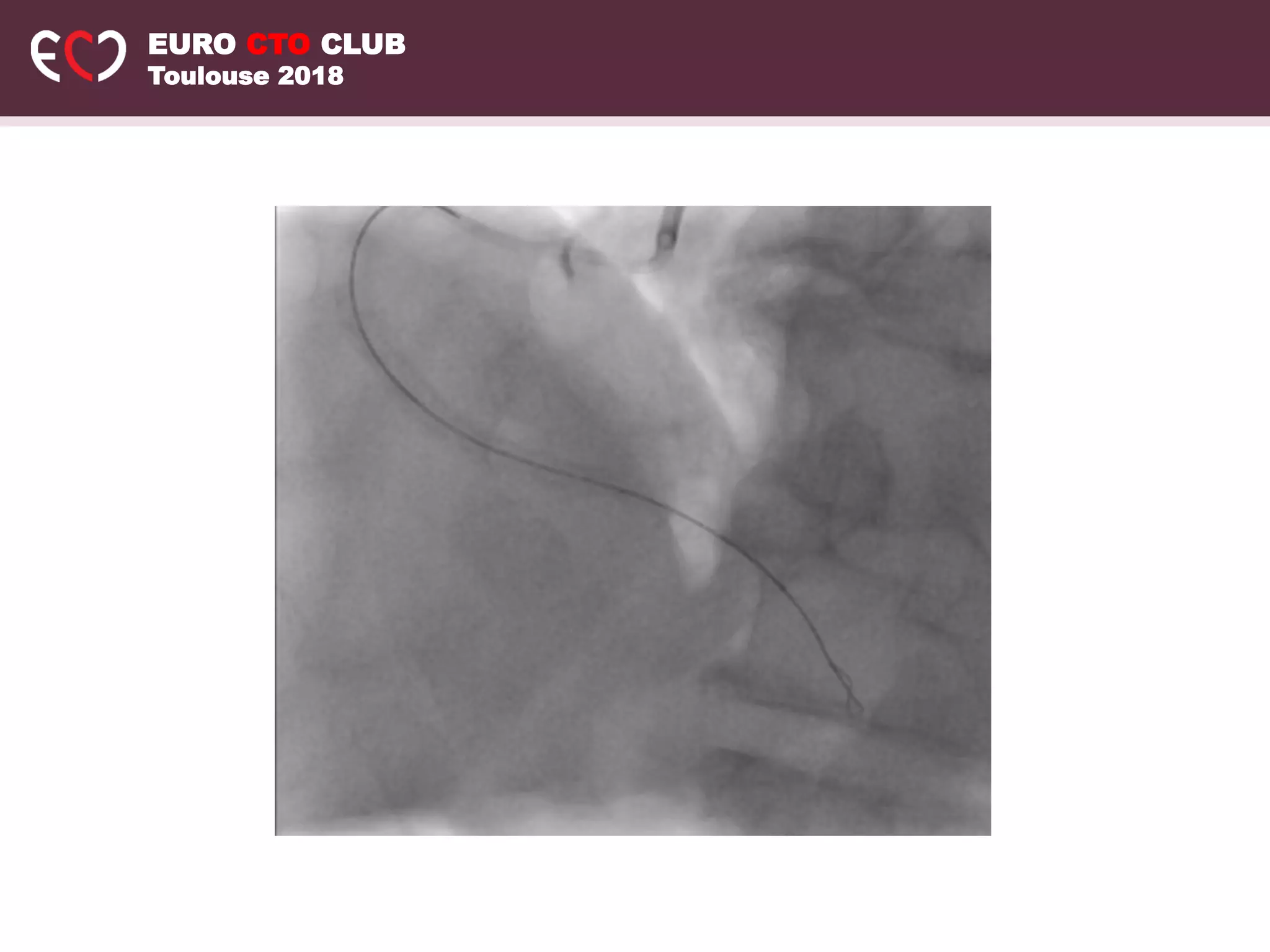 Guide catheter extensions and CTO PCI | PDF