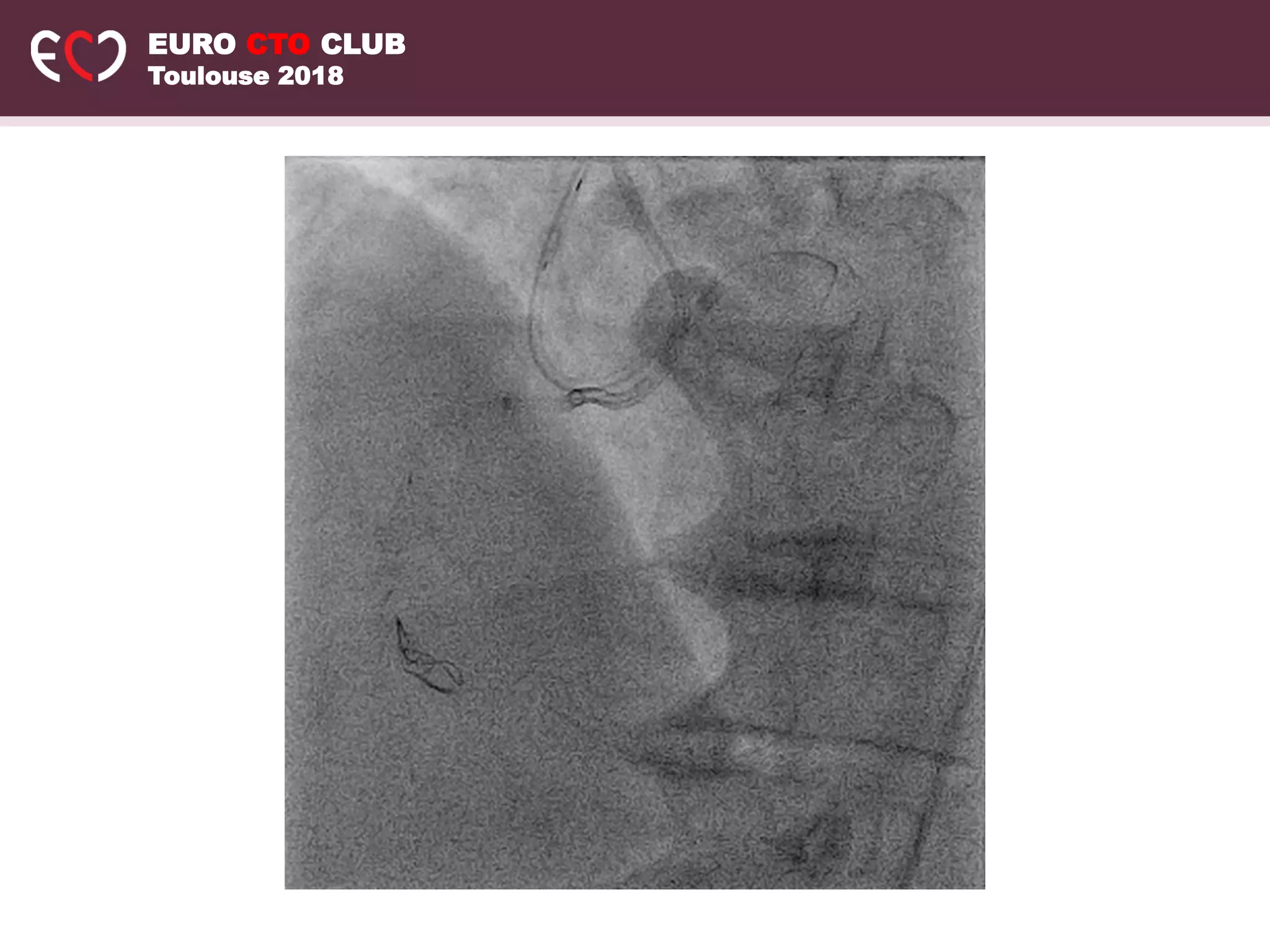 Guide catheter extensions and CTO PCI | PDF