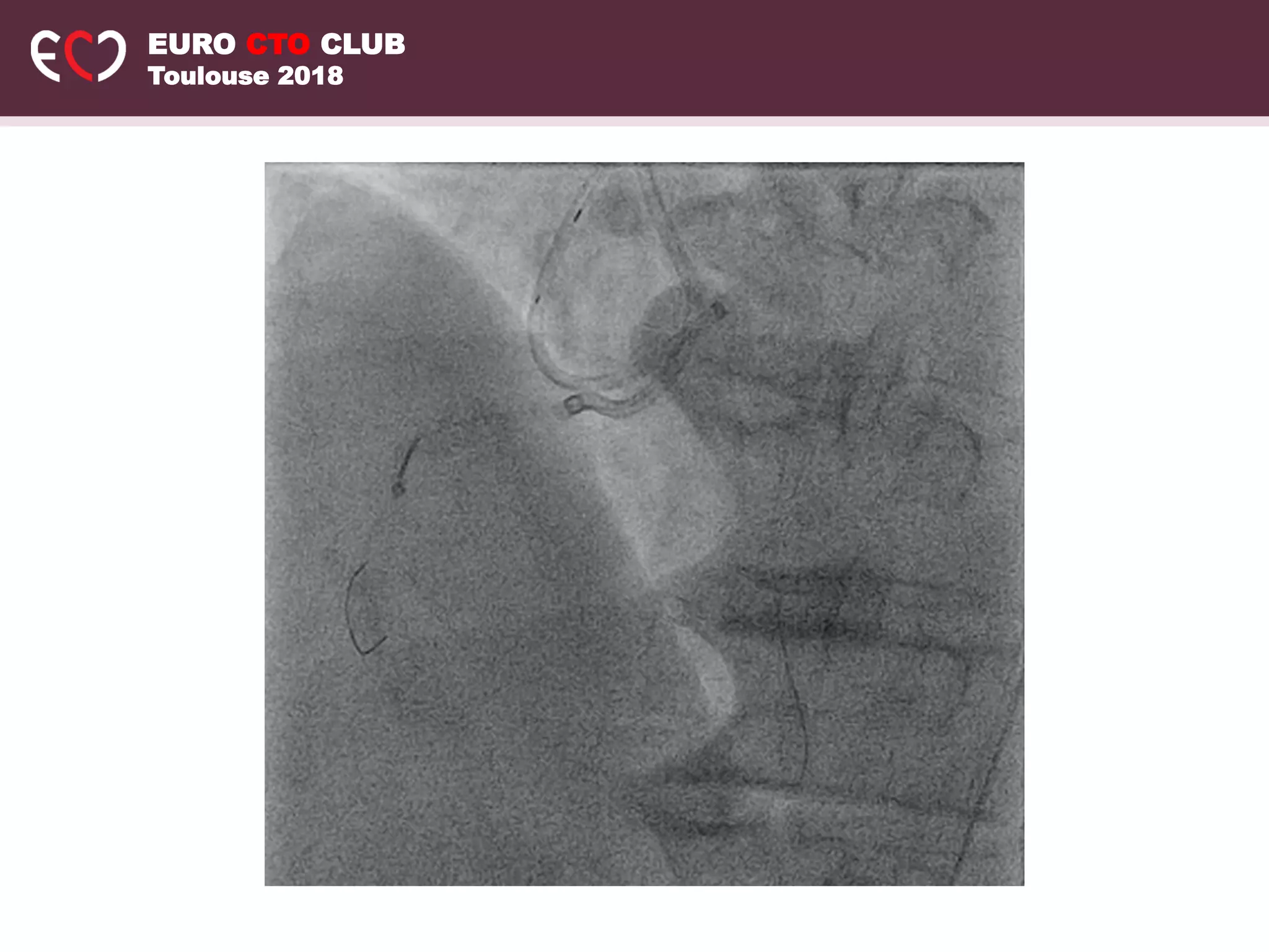 Guide catheter extensions and CTO PCI | PDF