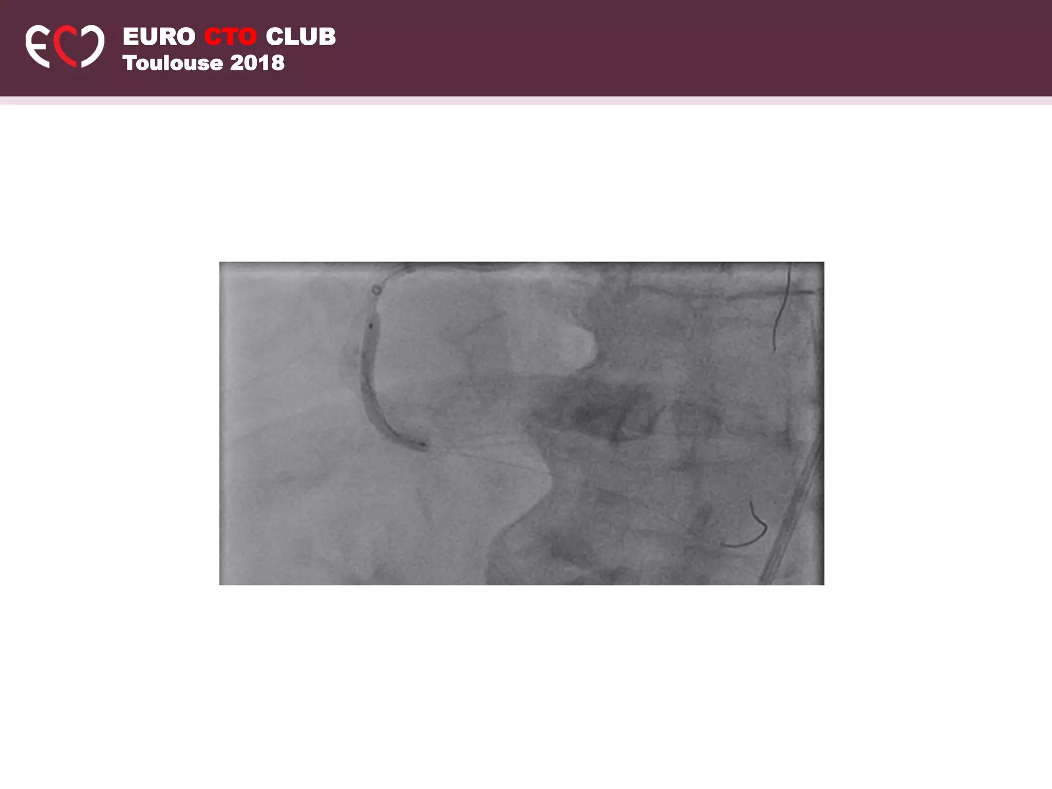 Guide catheter extensions and CTO PCI | PDF