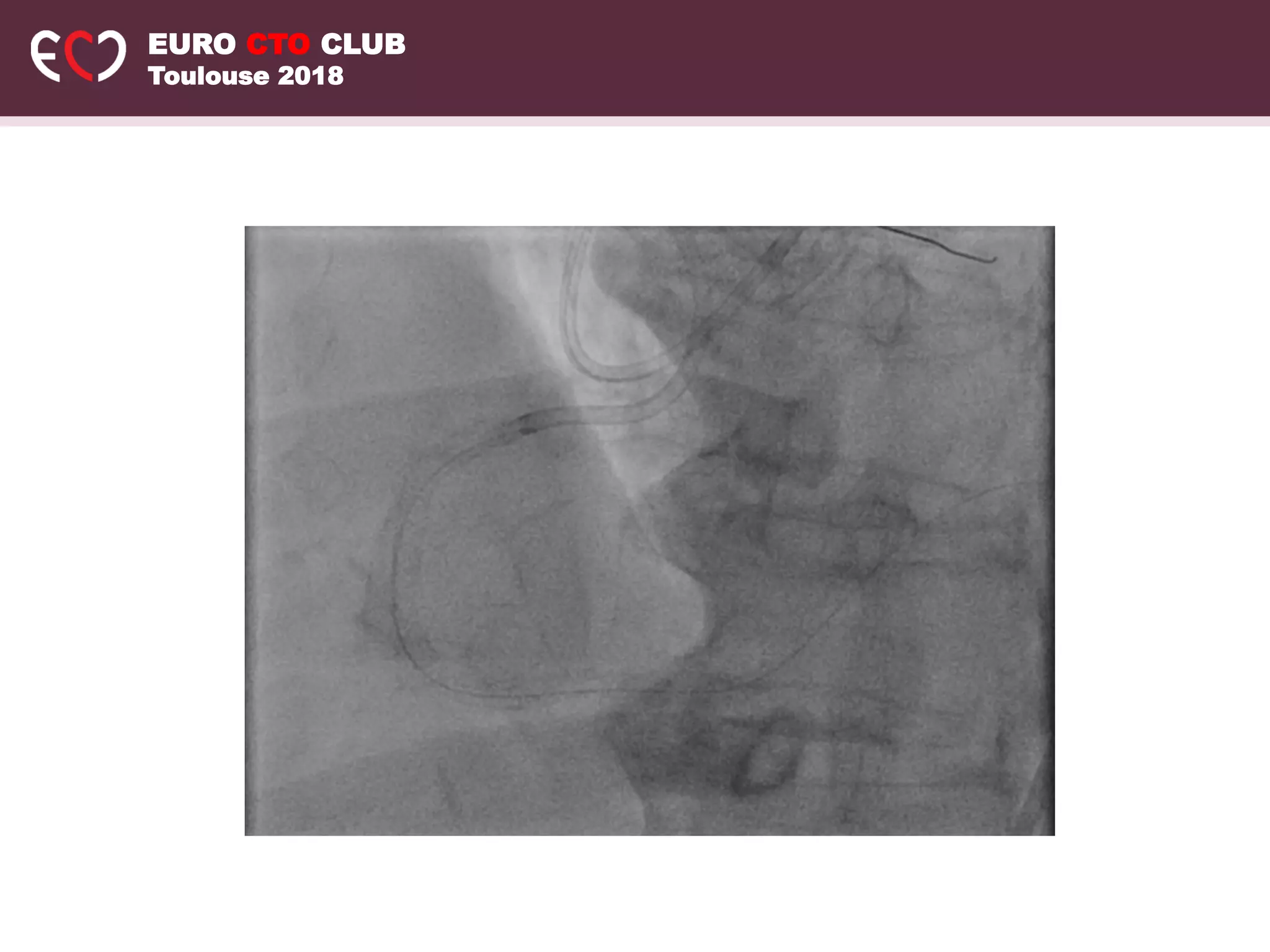Guide catheter extensions and CTO PCI | PDF