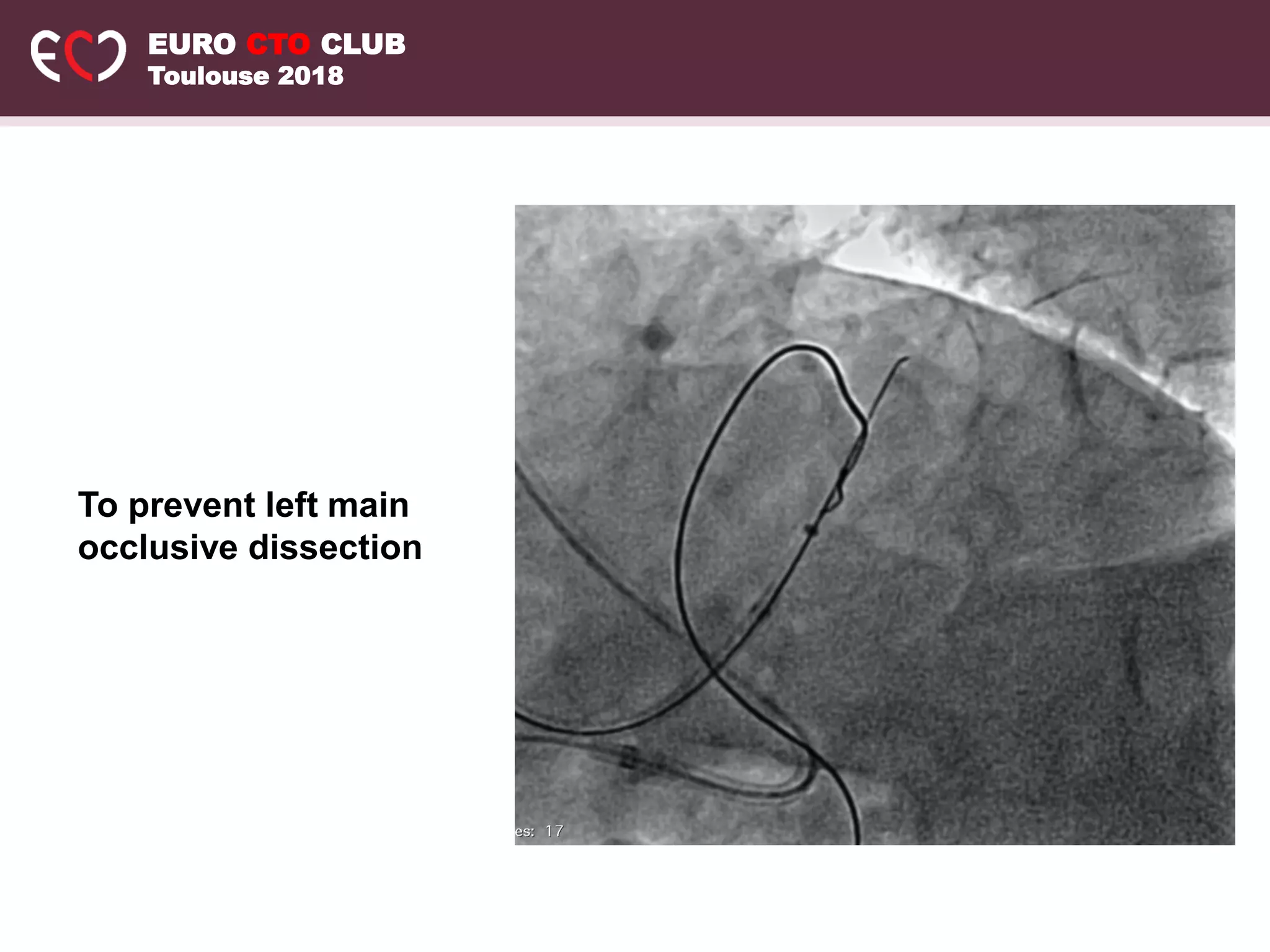 Guide catheter extensions and CTO PCI | PDF
