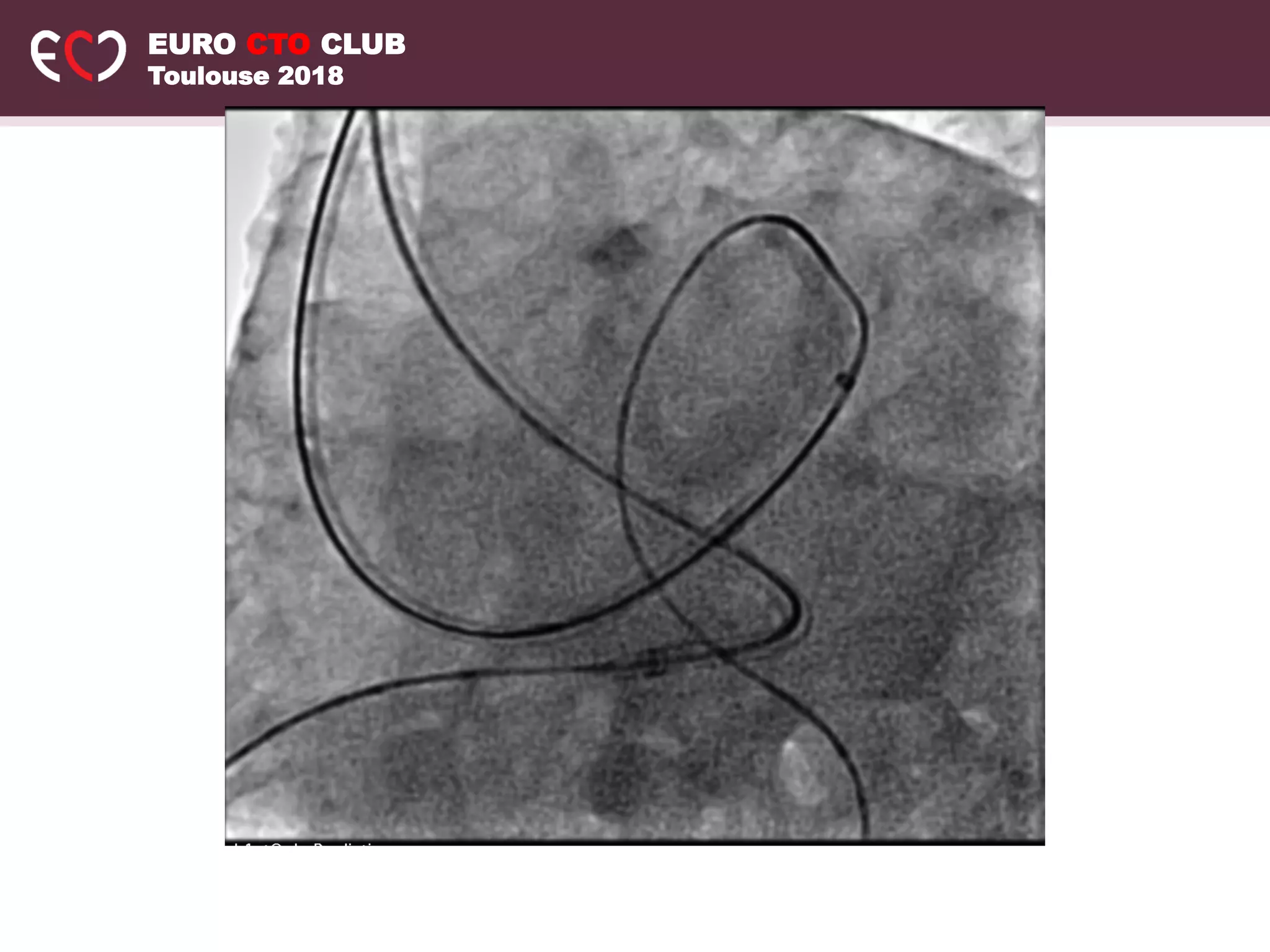 Guide catheter extensions and CTO PCI | PDF