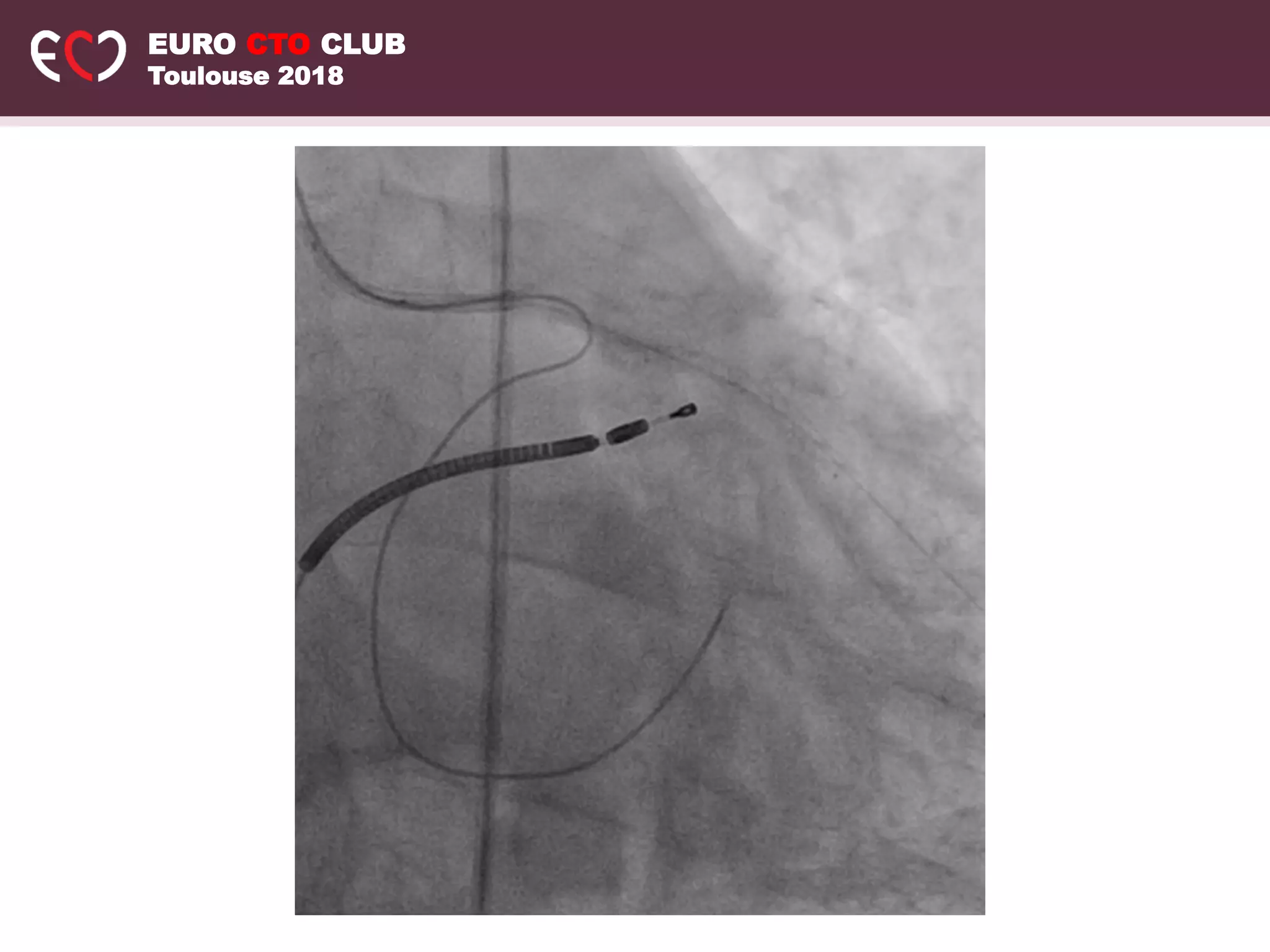 Guide catheter extensions and CTO PCI | PDF
