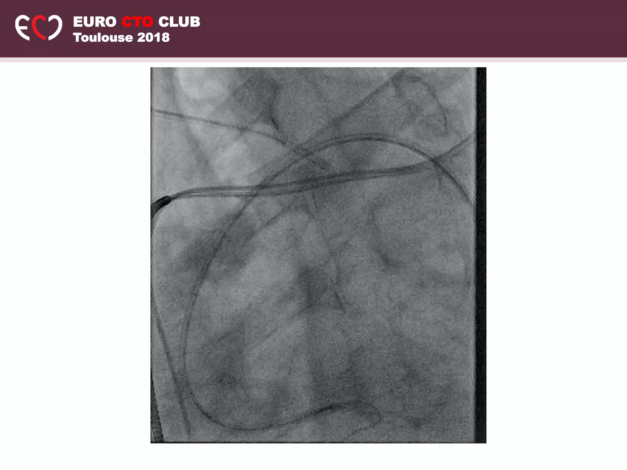 Guide catheter extensions and CTO PCI | PDF