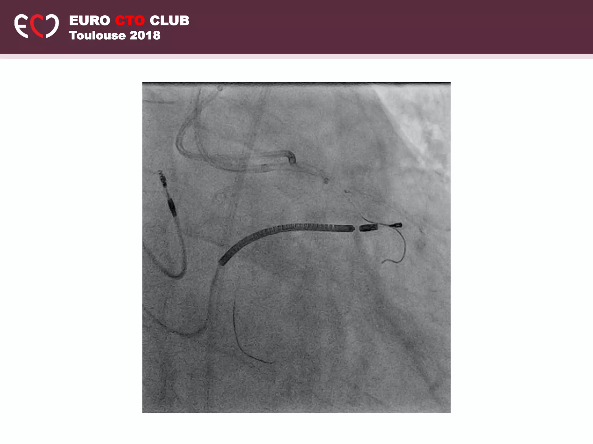 Guide catheter extensions and CTO PCI | PDF