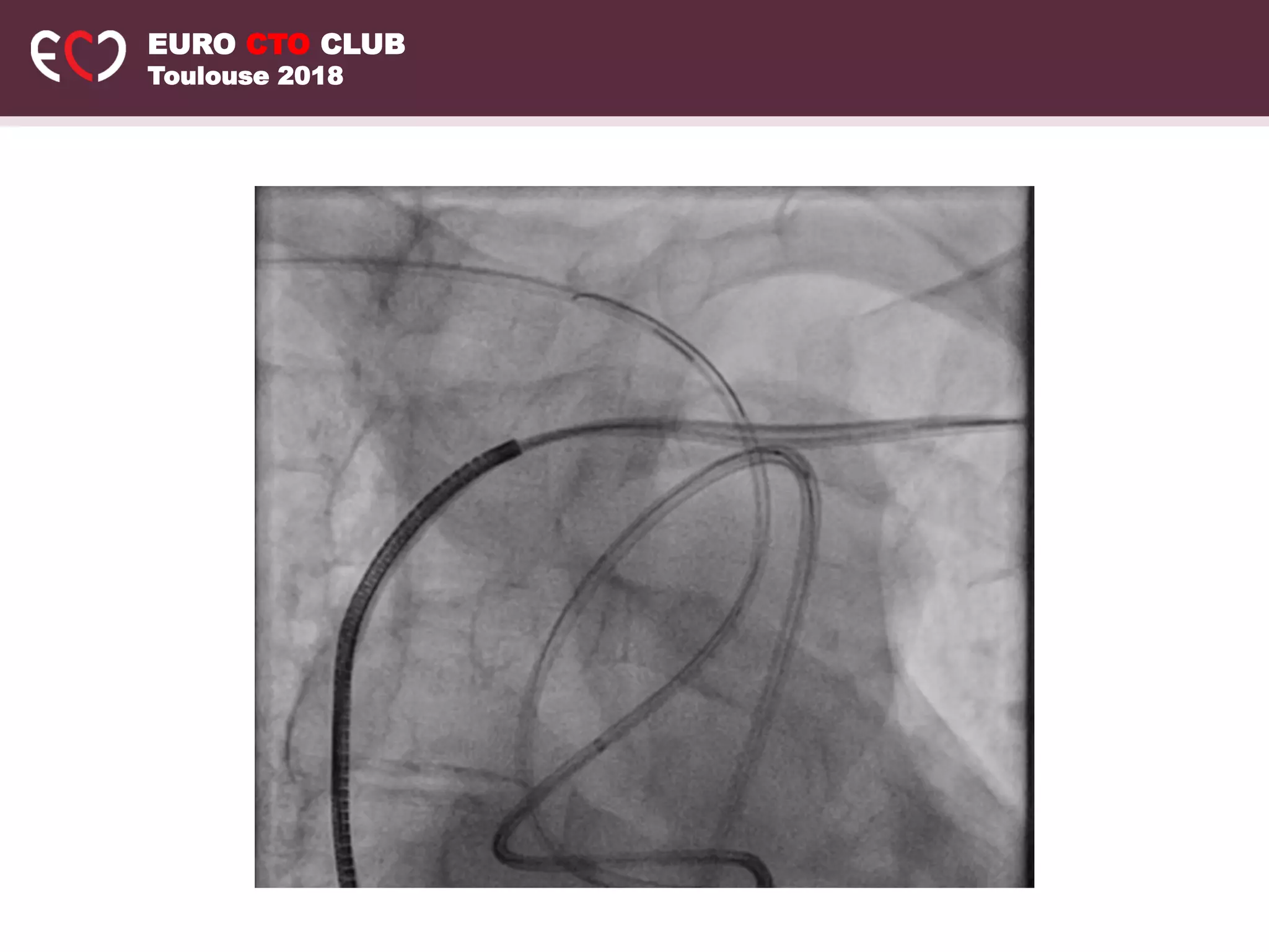 Guide catheter extensions and CTO PCI | PDF
