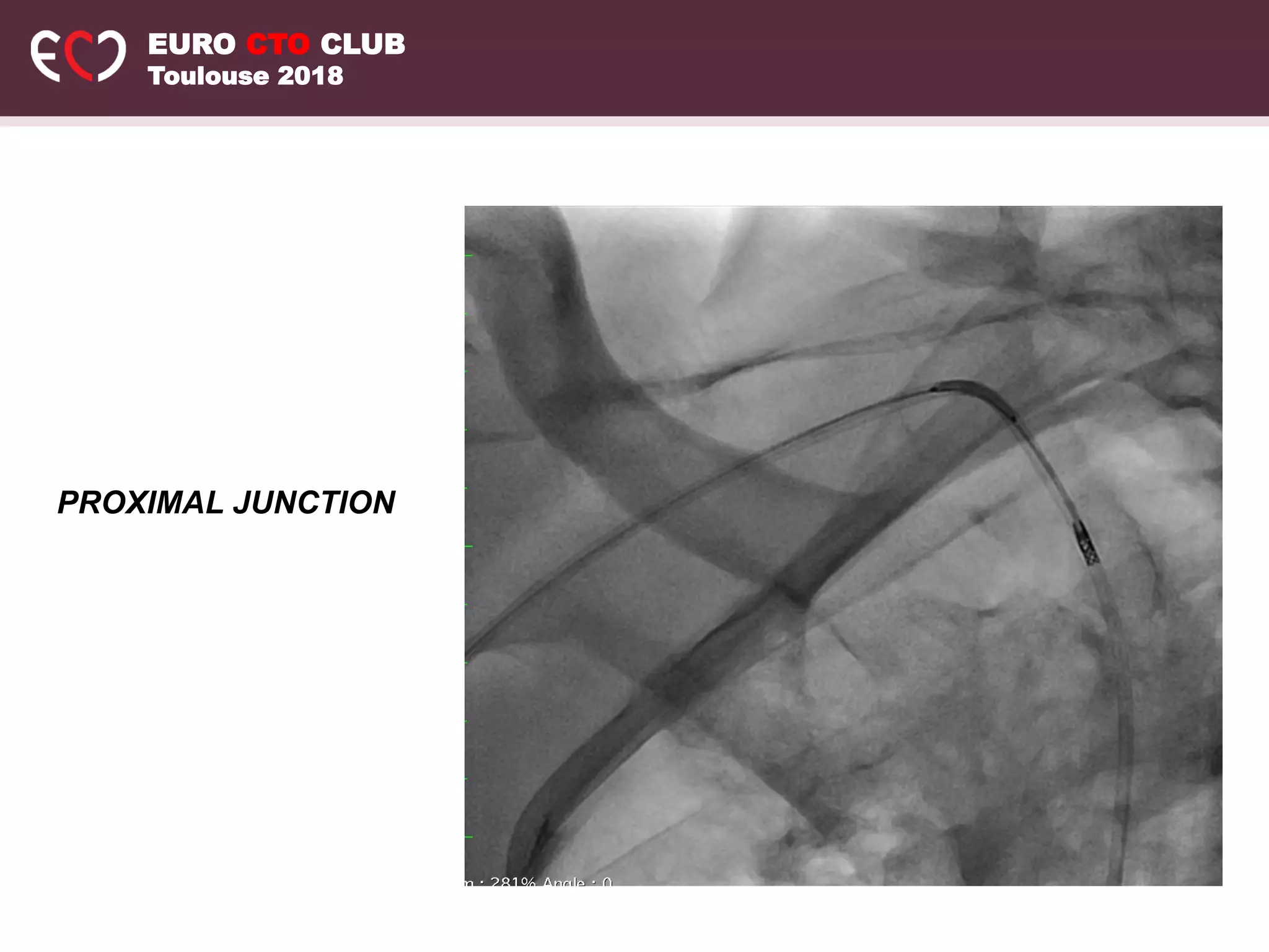 Guide catheter extensions and CTO PCI | PDF