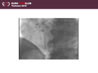 Guide catheter extensions and CTO PCI | PDF