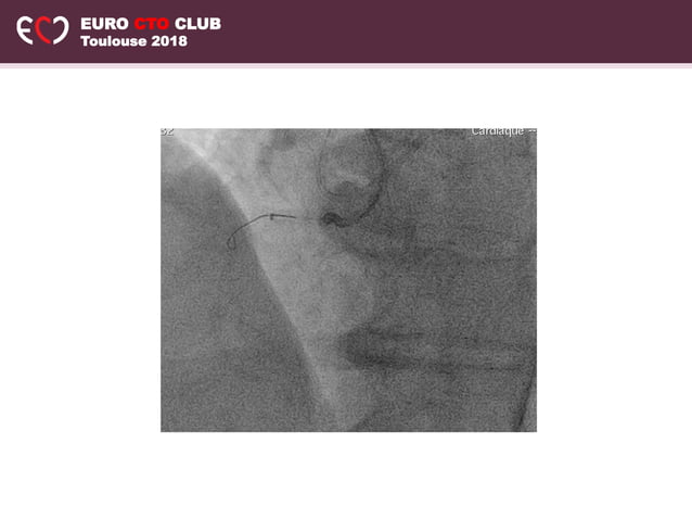 Guide catheter extensions and CTO PCI | PDF | Death, Injury, or ...