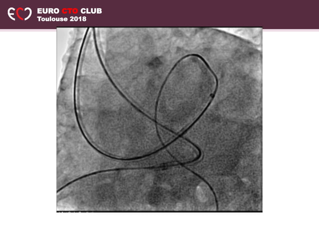 Guide catheter extensions and CTO PCI | PDF | Death, Injury, or ...
