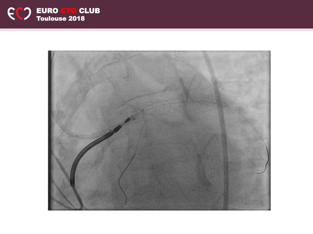 Guide catheter extensions and CTO PCI | PDF | Death, Injury, or ...