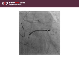 Guide catheter extensions and CTO PCI | PDF