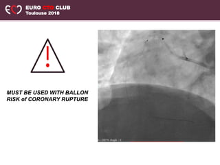Guide catheter extensions and CTO PCI | PDF