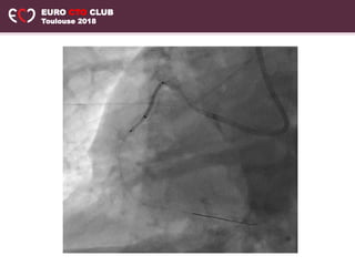 Guide catheter extensions and CTO PCI | PDF