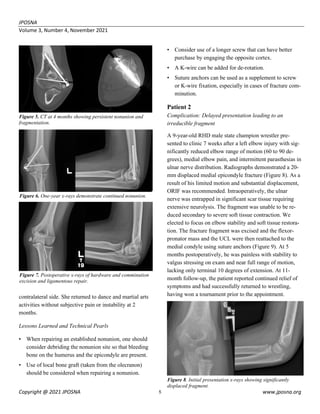 ldushane,+JPOSNA+365+NOV+2021+-+Current+Concept+Review+-+FINAL (1).pdf