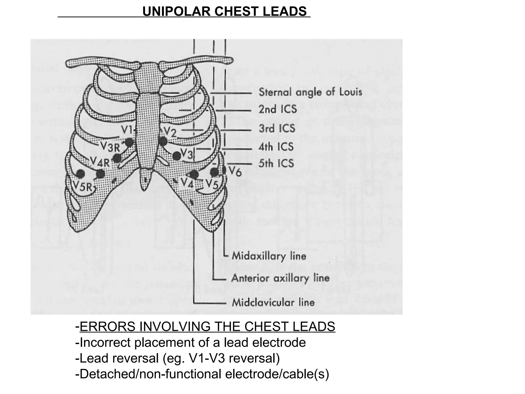 Lead errors introduction | PPT | Heart and Cardiovascular Diseases ...