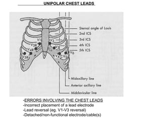 Lead errors introduction | PPT | Heart and Cardiovascular Diseases ...