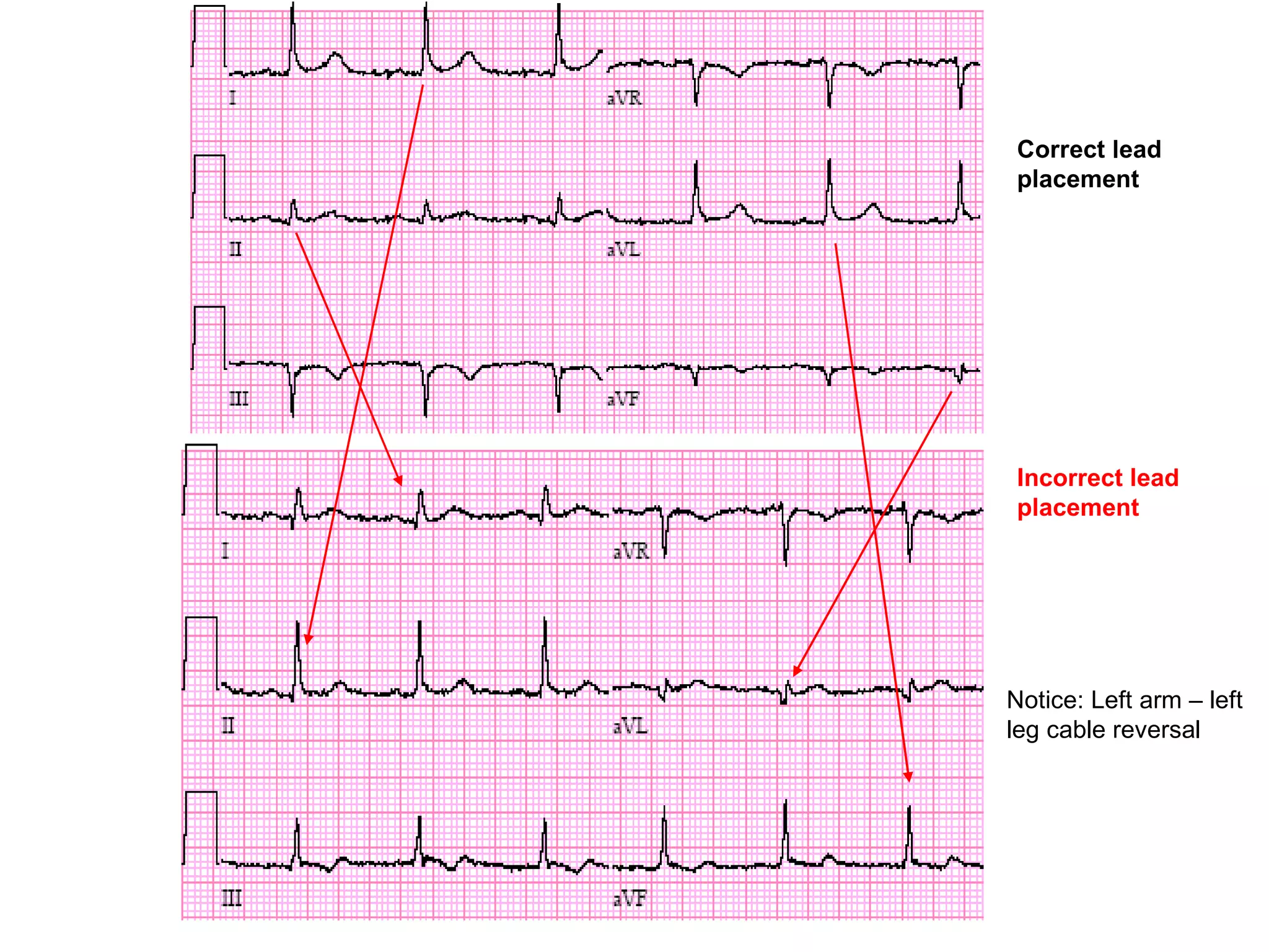 Lead Errors Reversal Of Limb Leads Ppt
