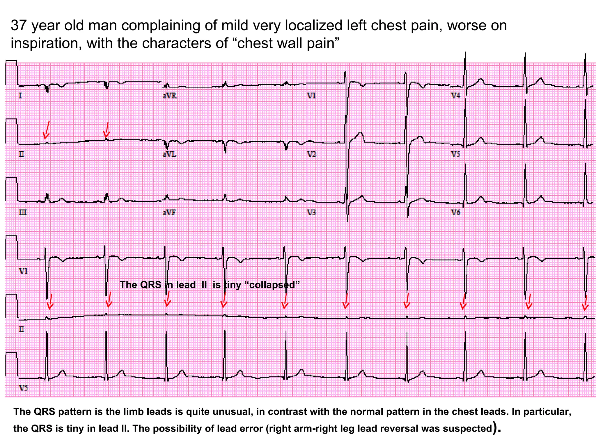 Lead errors: reversal of limb leads | PPT