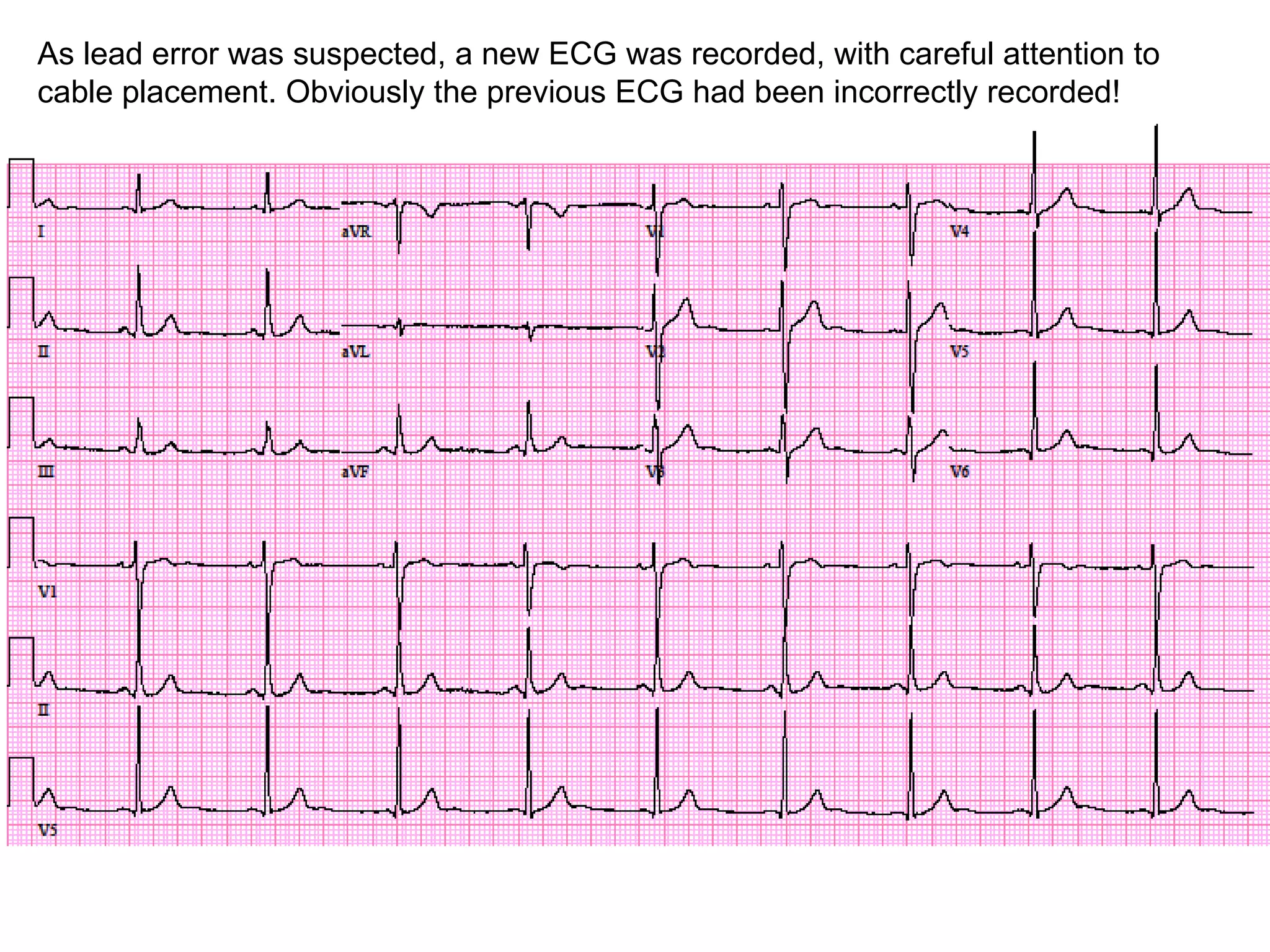 Lead Errors Reversal Of Limb Leads Ppt