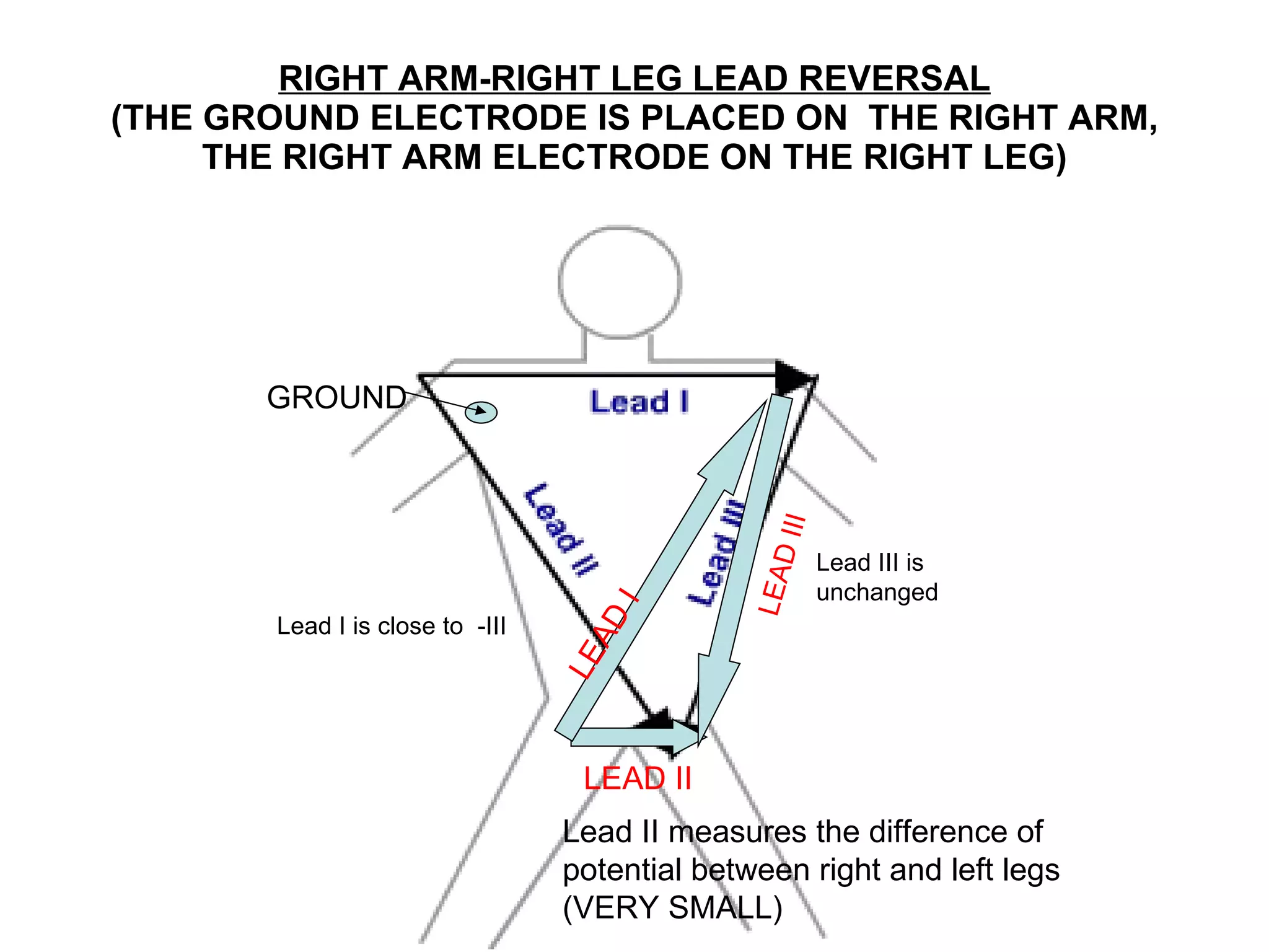 Lead Errors Reversal Of Limb Leads Ppt