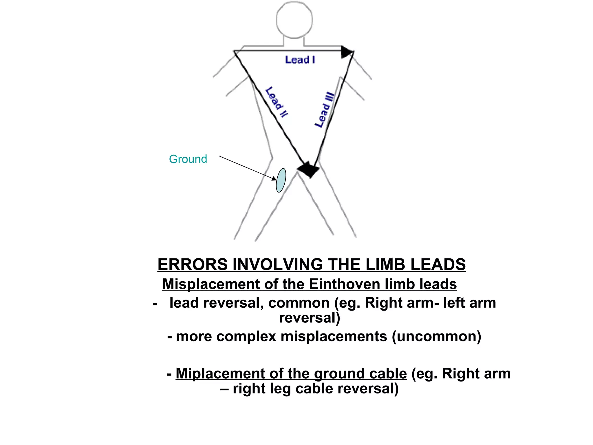 Lead errors: reversal of limb leads | PPT