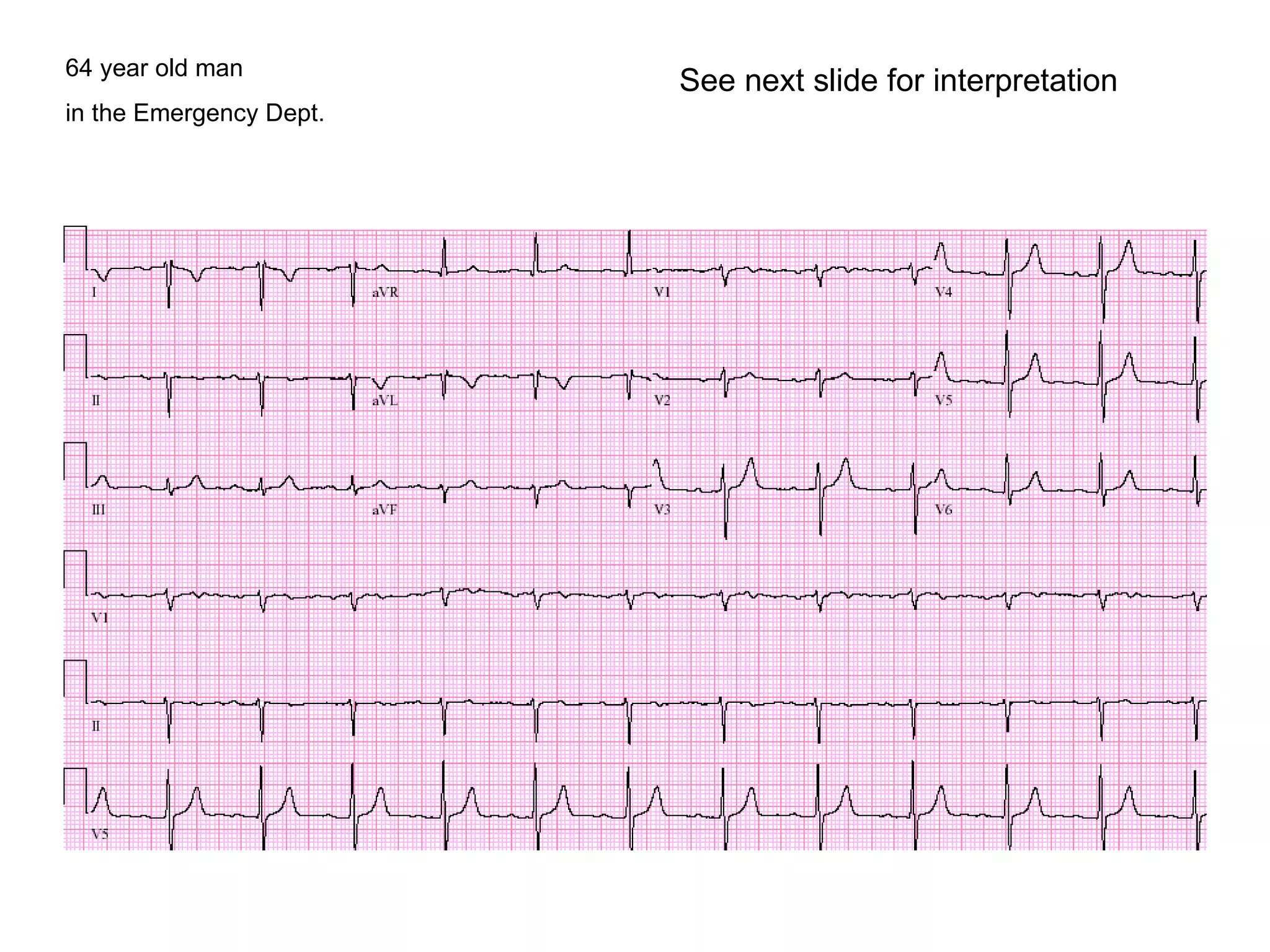Lead errors: reversal of limb leads | PPT