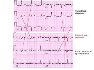 Lead errors: reversal of limb leads | PPT