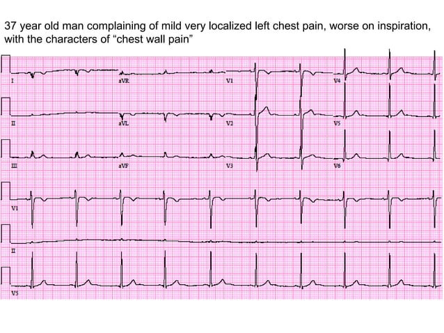 Lead errors: reversal of limb leads | PPT