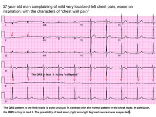 Lead errors: reversal of limb leads | PPT