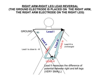 Lead errors: reversal of limb leads | PPT