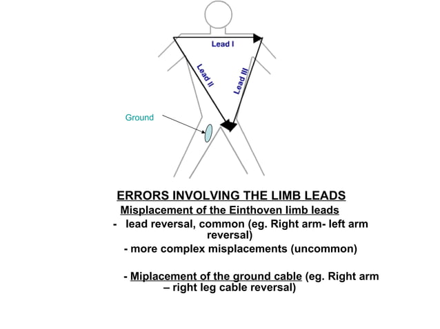 Lead errors: reversal of limb leads | PPT