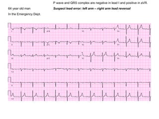 Lead errors: reversal of limb leads | PPT