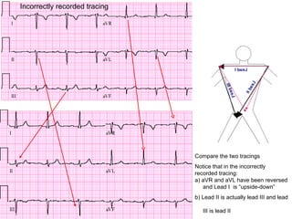 Lead errors: reversal of limb leads | PPT