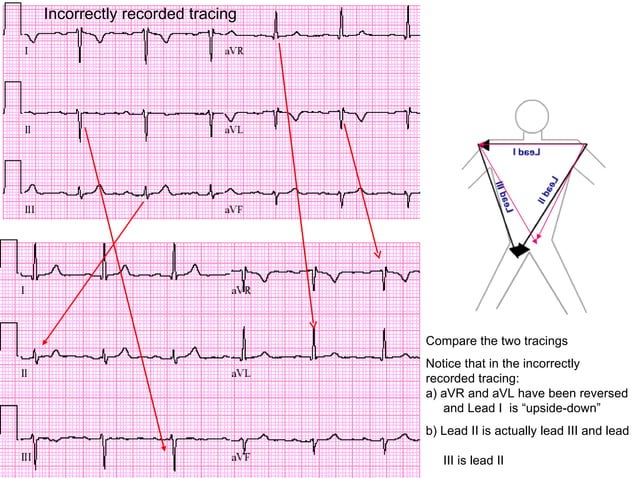 Lead Errors Reversal Of Limb Leads Ppt