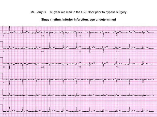 Lead errors: reversal of limb leads | PPT