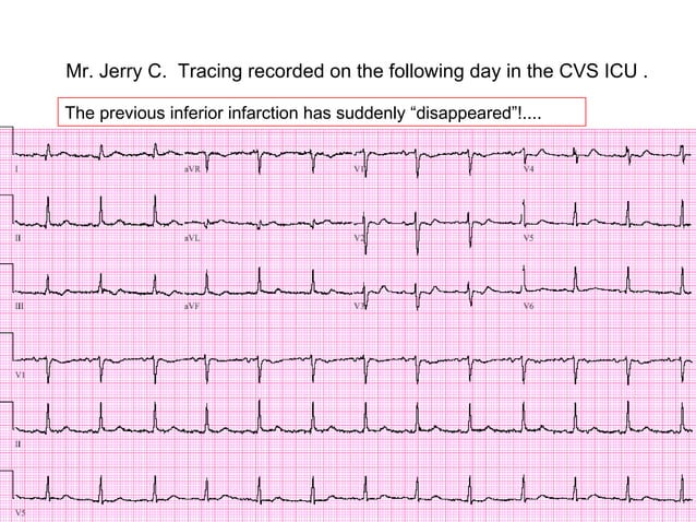 Lead Errors Reversal Of Limb Leads Ppt