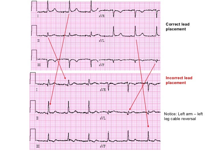 Lead errors: reversal of limb leads