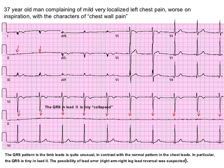 Lead Errors Reversal Of Limb Leads