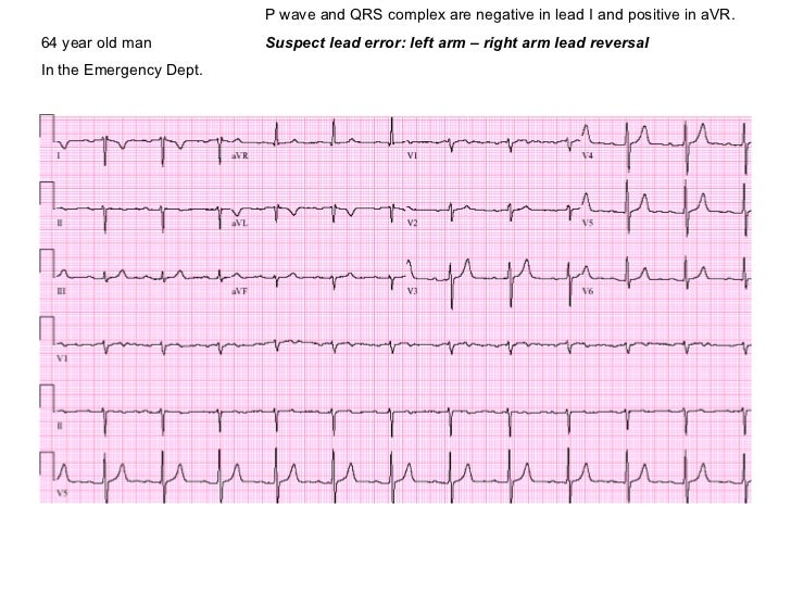 Lead errors: reversal of limb leads