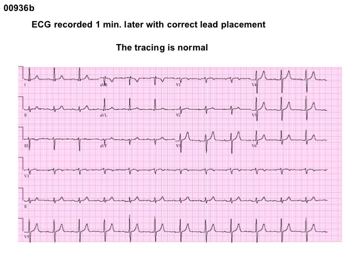 Lead errors: reversal of limb leads