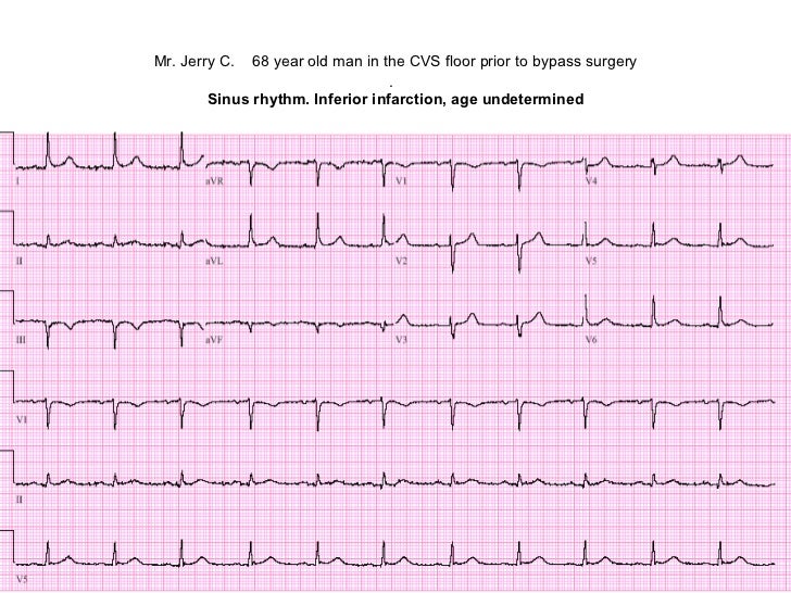 Lead errors: reversal of limb leads