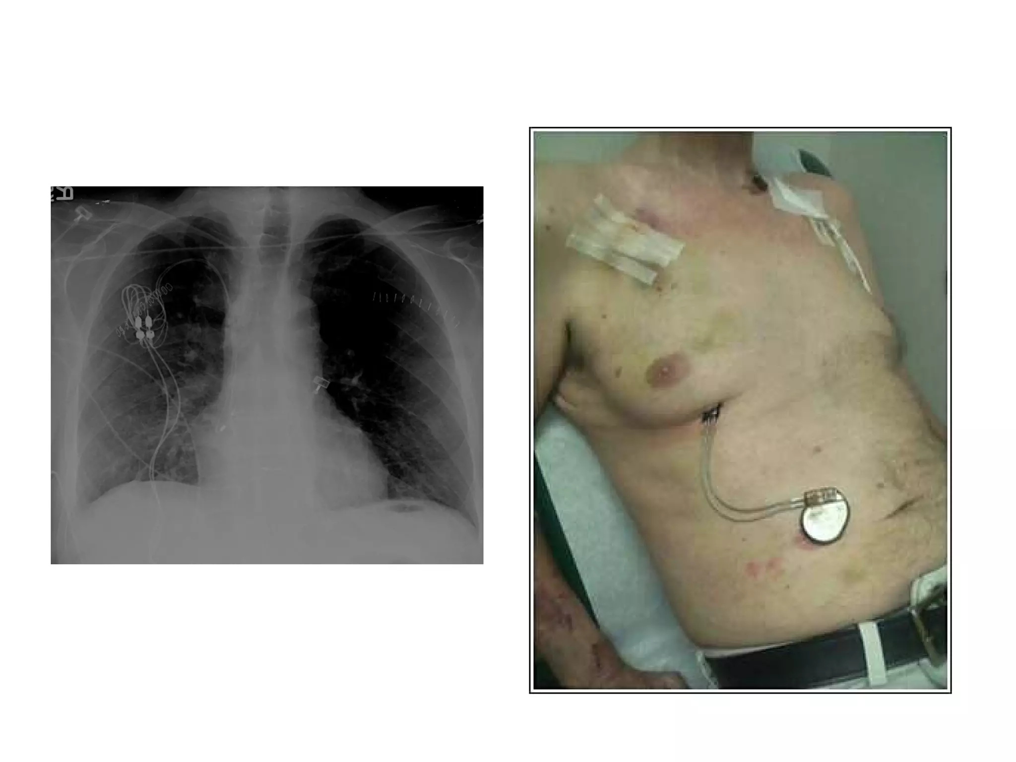 How to Manage the Patient with CIED Infection? | PPT