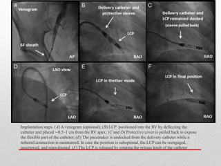 Leadless pacemaker | PPTX