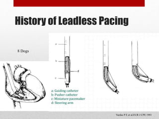 Leadless pacemaker | PPTX